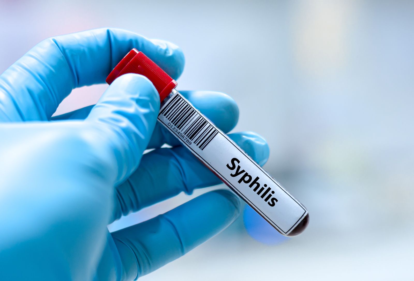 Tripper und Syphilis: Geschlechtskrankheiten breiten sich in Europa aus